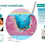 Úlceras corneales complicadas - Laboratorio Santgar