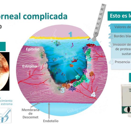 Úlceras corneales complicadas - Laboratorio Santgar